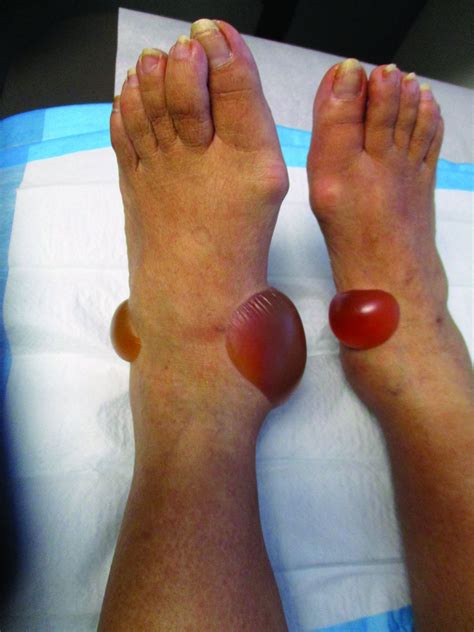 7815 Bullous Disorders Including Pemphigus Vulgaris Pemphigus Foliaceou