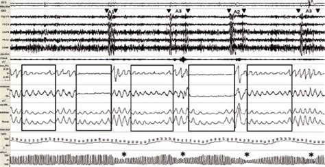 Modulation Of Eeg Responses Based On Respiratory Events Respiratory
