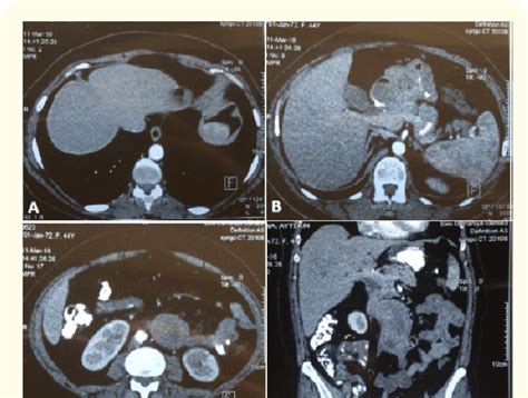 Ct View Of The Gastric Giant Adenoma Embedded In The Duodenum A The Download Scientific
