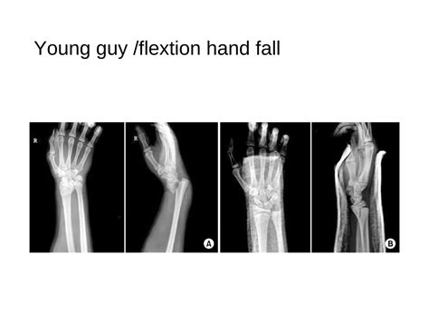 Distal Radius And Scaphoid Fracture Ppt