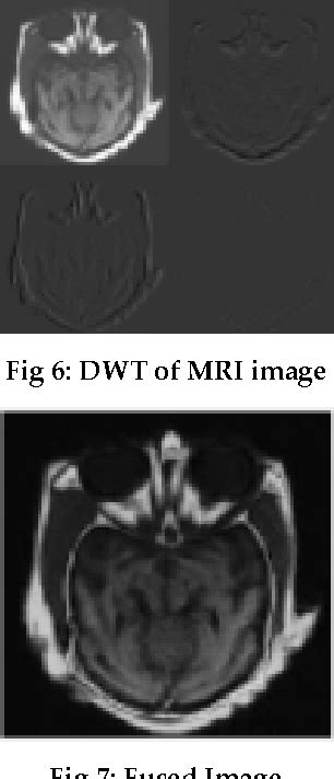 Figure 6 From Vlsi Implementation Of Medical Image Fusion Using Haar