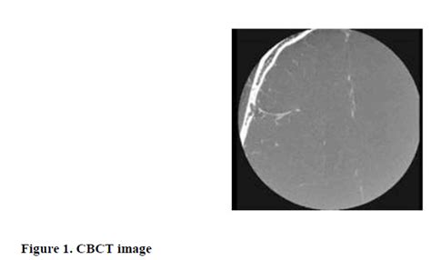 Collateral Circulation Characteristic Based On Cone Beam Computed Tomography Cbct Images In