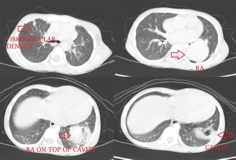 Contrast Enhanced Chest Ct Axial Cuts Example Of A Fibronodular Download Scientific Diagram