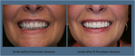 Porcelain Veneers Britt Dental Center Raleigh Nc Dentist