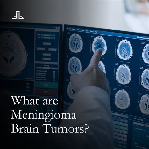 Johnson Law Group On Linkedin Meningiomas Are Slow Growing Typically Benign Tumors That Form