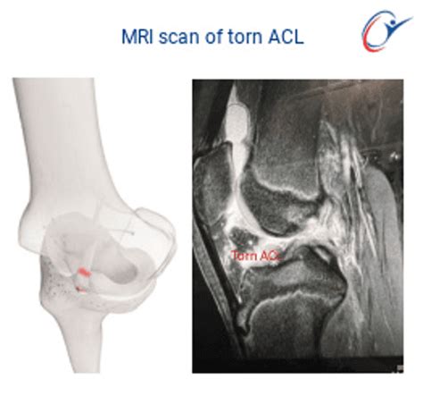 Knee Acl Tear Assic Education