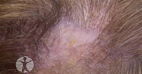 Lichen Planopilaris Image