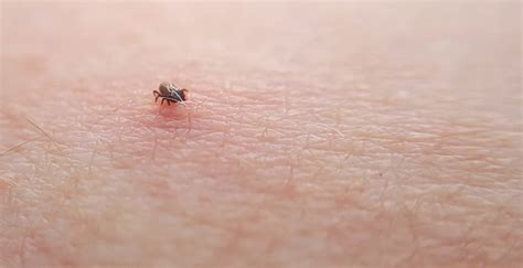 틱 매크로 사진 인간의 피부에 Ixodes Ricinus 분홍색 자극받은 표피 배경에 물린 부풀어 오른 기생충 거미류에 대한