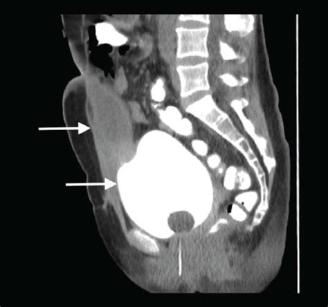 Cystography Showing The Bladder Filled With Contrast Arrow Below Download Scientific Diagram