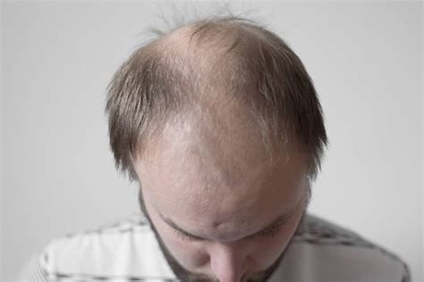Can Depression Be A Cause Of Hair Loss Here Are 5 Things To Do About