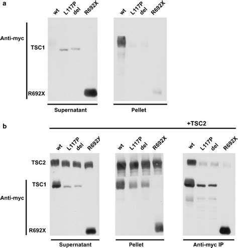 Missense Mutations To The Tsc1 Gene Cause Tuberous Sclerosis Complex European Journal Of Human