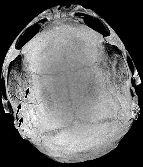 The Skull Unfolded A Cranial Ct Visualization Algorithm For Fast And Easy Detection Of Skull