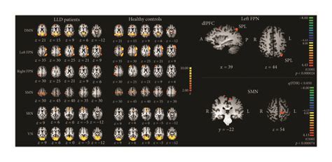 Resting State Networks Rsns In Late Life Depression Lld Left Panel