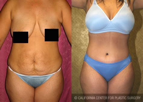 Tummy Tuck Before And After Stretch Marks