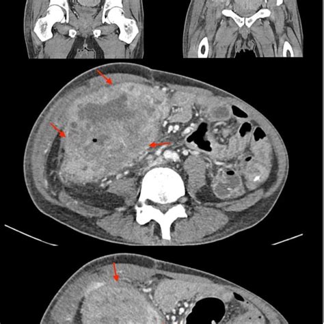 Computerized Tomography Scan Of Male Patient Showing A Large Complex Download Scientific