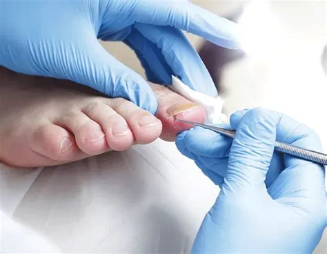 Ingrown Toenail For Savannah Tn And Corinth Ms Dr Robert Darrin Hurst Podiatrist