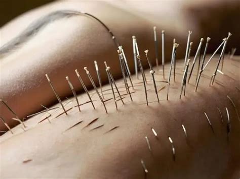 Exploring Acupuncture As A Holistic Treatment For Ibs In Richmond