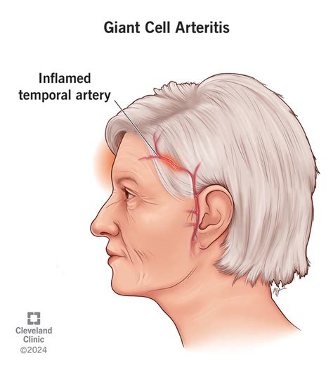 Giant Cell Arteritis Temporal Arteritis Signs And Treatment