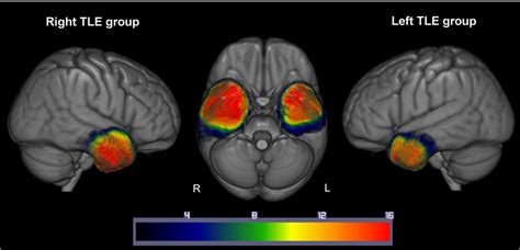 Figure 1 From The Roles Of Left Versus Right Anterior Temporal Lobes In Semantic Memory A