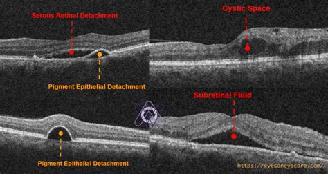 Oct Differentiation In Retinal And Sub Retinal Fluid Virtual Ophthalmology Academy Posted On