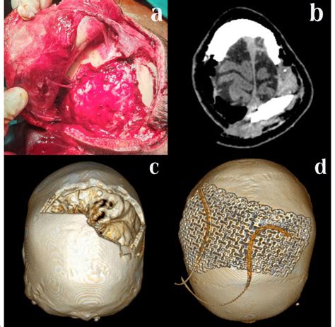 A The Open Wound Of Scalp With Bleeding And Large Skull Defect B Ct