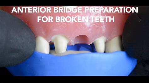 What Is A Bridge After Tooth Extraction At Audrey Brabyn Blog