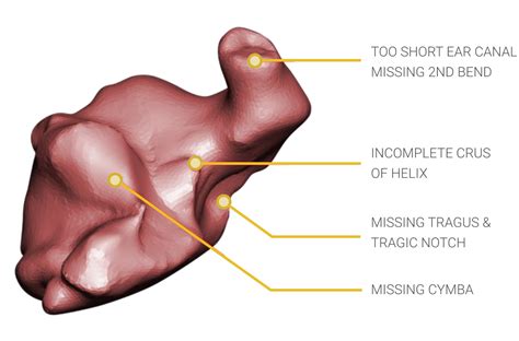 Impression Guide Flipears