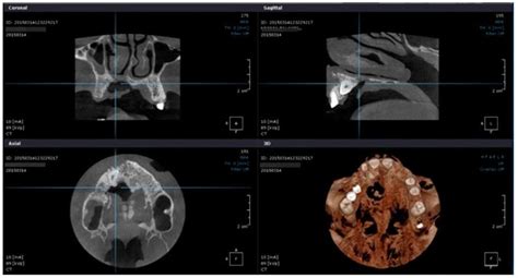 Oronasal Communication Cone Beam Computer Tomography Cbct Aspect