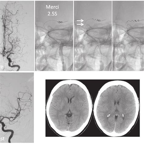 Analysis Of The Curve Angle Of The Horizontal Mca Segment M1 A M1