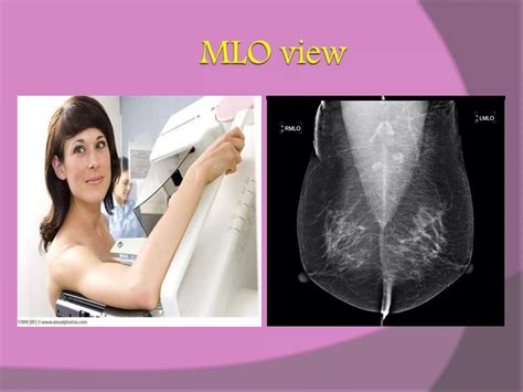 Mammography Pptx