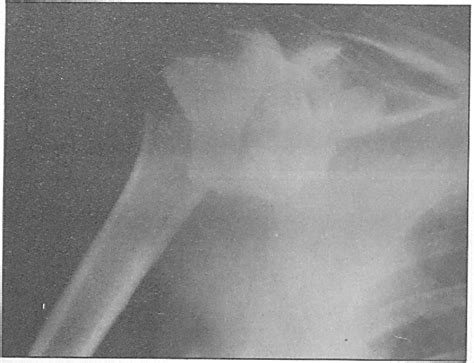 Acromionectomy Semantic Scholar