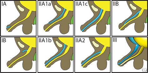 Case Of Urethral Duplication Seen By Voiding Urosonography Clinical Imaging