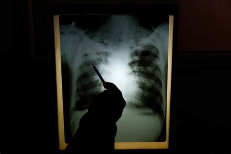 Mobile X Ray Program Being Brought To Residents Of Pei Long Term
