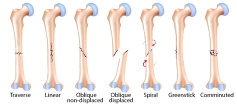 Different Types Of Bone Fracture Aslosweet