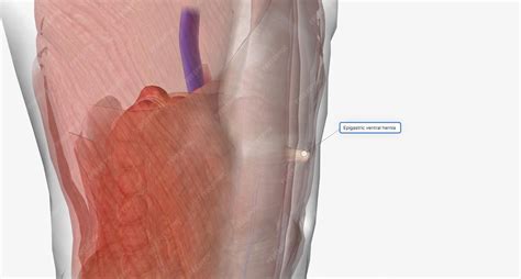 Premium Photo An Epigastric Ventral Hernia Is The Most Common Type Of