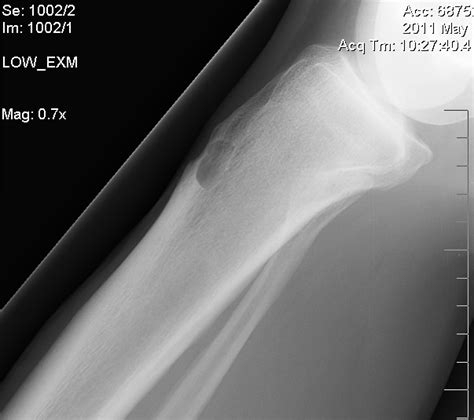 A 58 Year Old Man With A Right Proximal Tibia Lesion