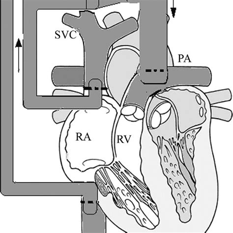 Temporary Total Cavopulmonary Connection T TCPC System The Superior Download Scientific