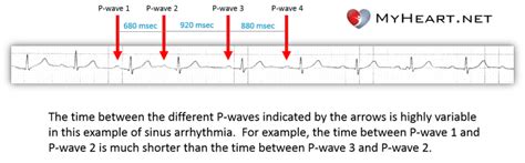 Respiratory Sinus Arrhythmia