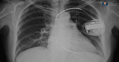 AICD Implant Types Functions Procedure Precautions Needed