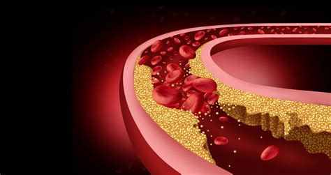 Cholesterol And Particle Testing Revolution Health And Wellness