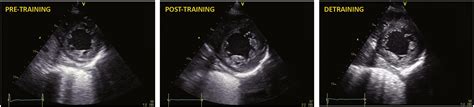 Exercise Induced Left Ventricular Hypertrabeculation In Athletes Heart