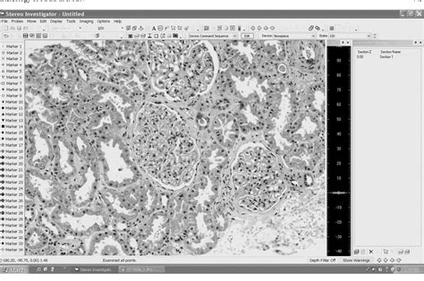 Figure 1 From Focal Segmental Glomerulosclerosis In Idiopathic Membranous Glomerulonephritis A