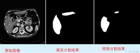 计算机视觉 02 基于u net的肝脏肿瘤分割（包含数据和代码） vnet 3d肝脏分割代码 csdn博客