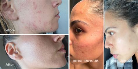 Fungal Acne Before And After Almond Clear
