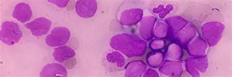 Investigating The Role Of Tp53 And Kmt2c Mutations In Aml With Chromosome 7 Deletions