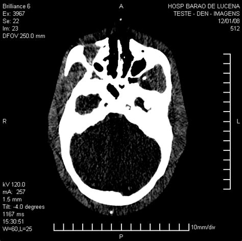 Levels Of Noise And Spatial Resolution For Two Different Reconstruction Download Scientific