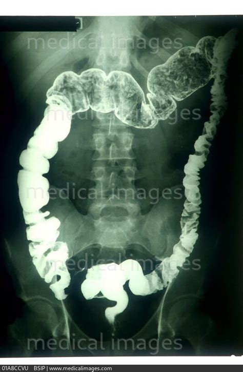 Stock Image 0839693 01a8ccvu Bsip Search Medical And Scientific