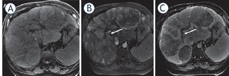 69 Year Old Man With Cirrhosis Due To Alcohol With Diffuse Infiltrative