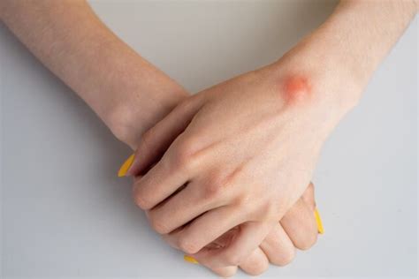 Ganglion In The Wrist And Fingers Treatment In Sg Tops Clinic