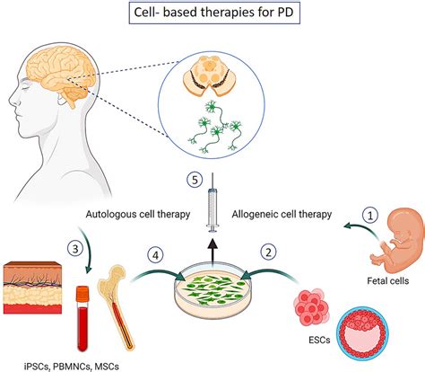 An Overview Of Cell Based Therapies For Pd Allogeneic Cell Therapy
